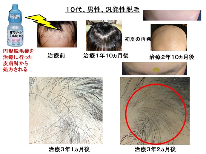 パタノール点眼液などで大量脱毛の患者さん、再発を経て突然産毛が！ |患者様からの声・メディア掲載・クリニックからのお知らせ | 名古屋Kクリニック